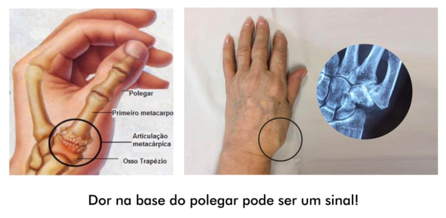 Rizartrose: Causas, sintomas e importância do acompanhamento
